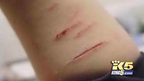 The dangerous addiction of cutting | king5.com