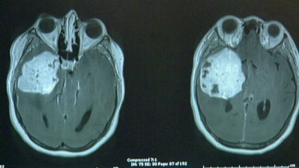 Arizona doctors remove softball-sized brain tumor | king5.com