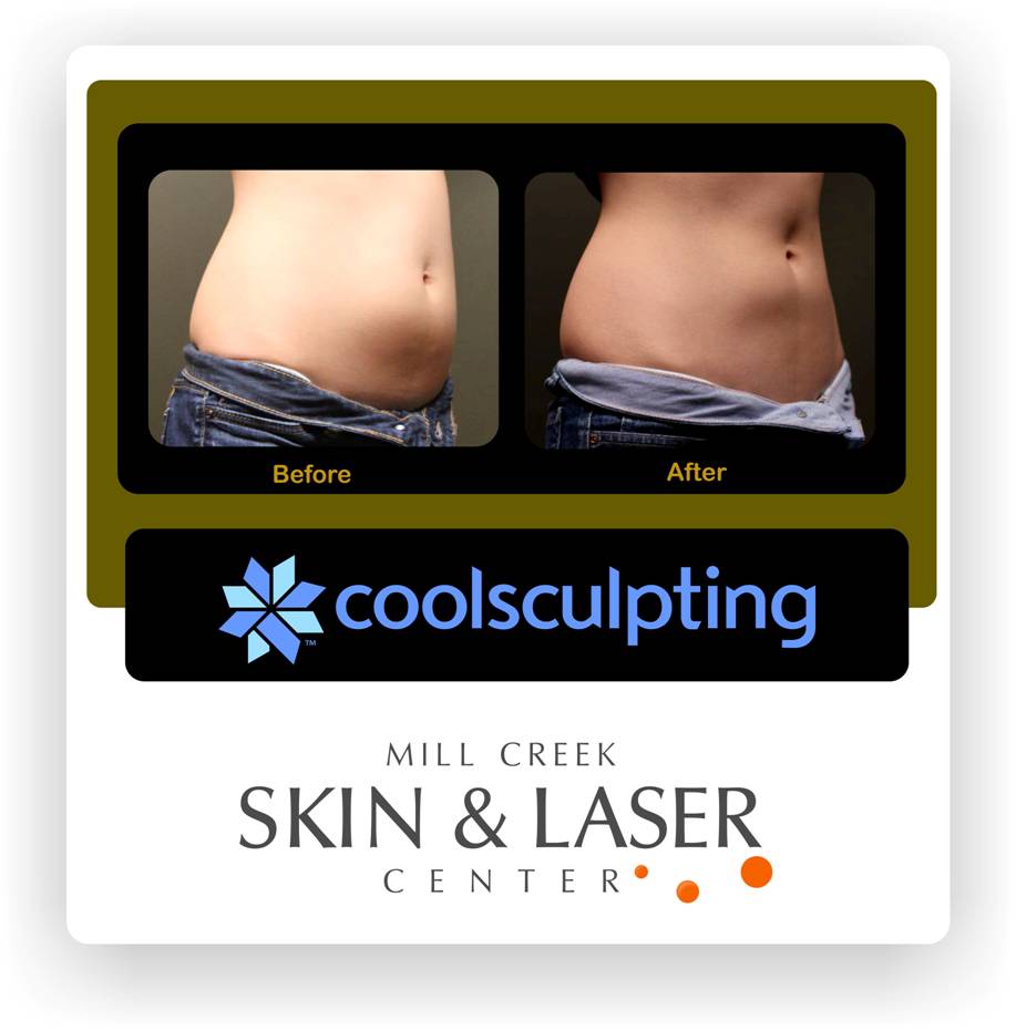 CoolSculpting procedure freezes away fat | king5.com