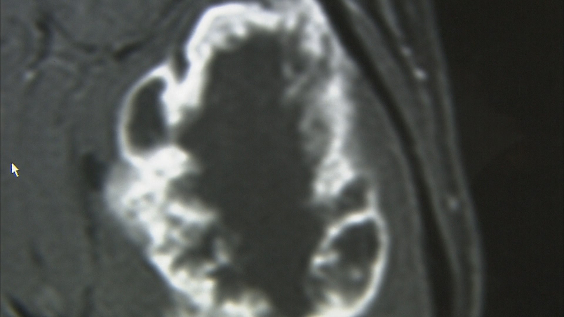 A road map to understanding deadly brain tumors | king5.com