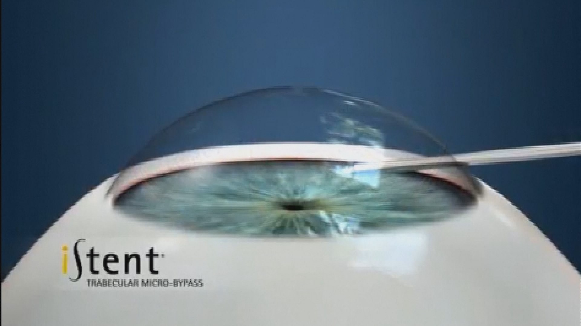 Miniature implant helps control glaucoma | king5.com