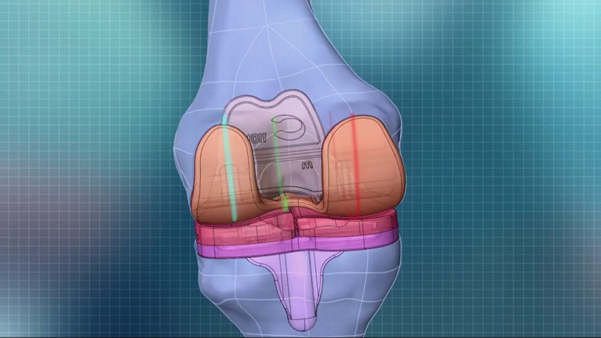 3D printer creates new knees | king5.com